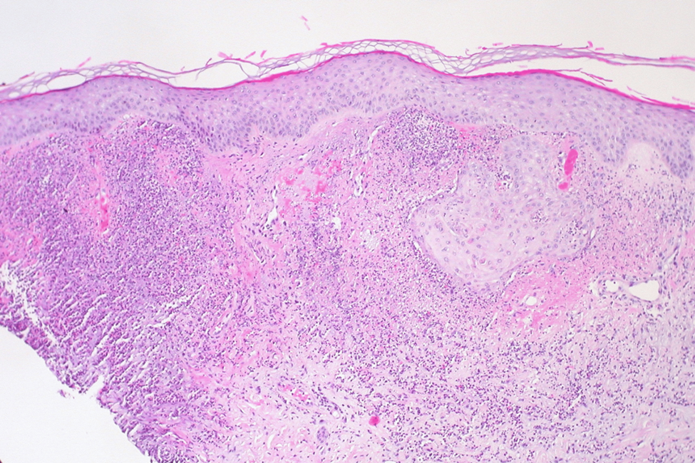 When Sweet Turns Sour: An Unusual Case of Acute Febrile Neutrophilic ...