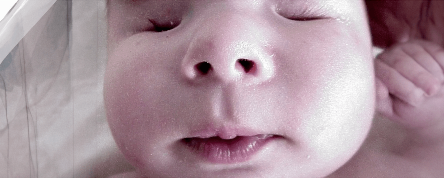 Anophthalmia: Rare Genetic Disorder Babies Born Without Eyes