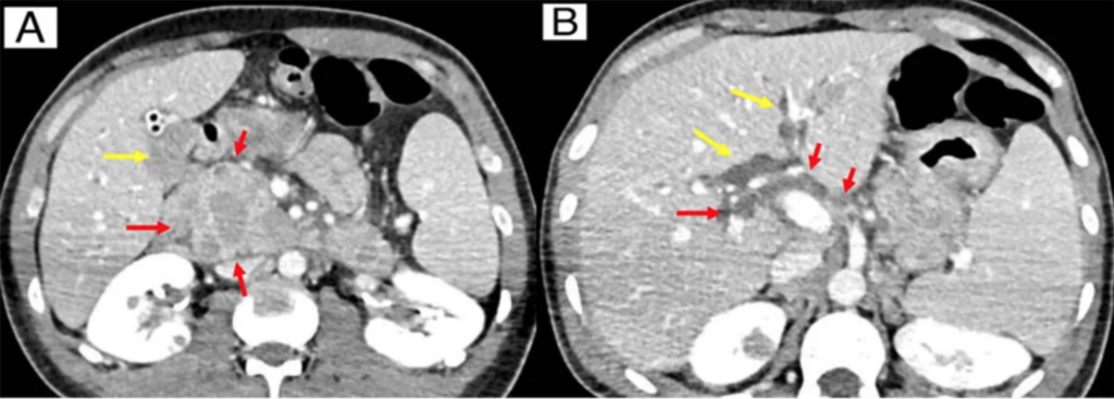 A Case of Gastric Burkitt Lymphoma in HIV/AIDS