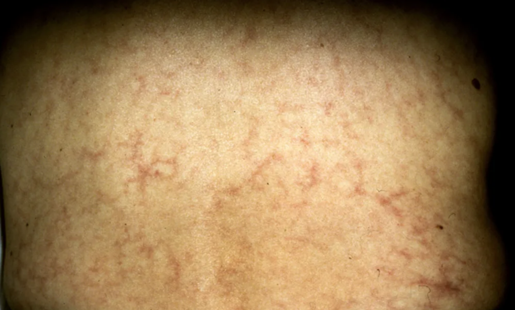 Sneddon Syndrome: Bridging Dermatology and Neurology: