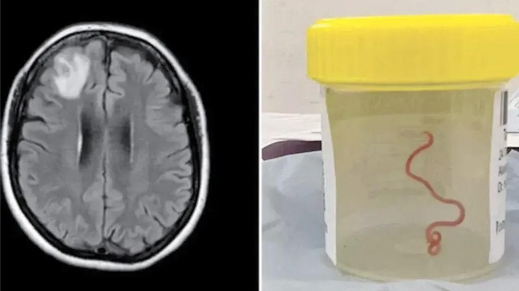 Neurocysticercosis: Undercooked Bacon Causing Migraines