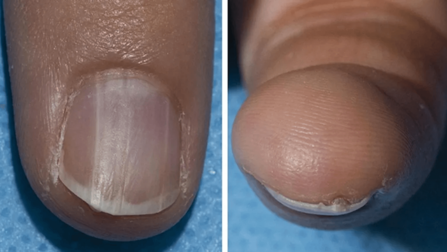 NIH: Benign Nail Conditions Linked to Rare Syndrome