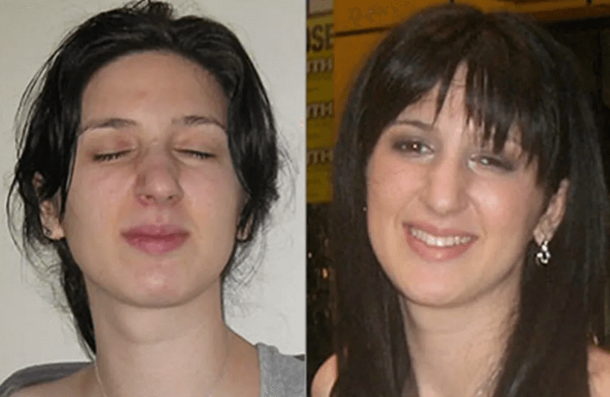 Mysterious Condition Leaves Woman Unable to Open Her Eyes