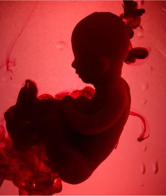 Milk Transfusions: The Bizarre Chapter in Medical History